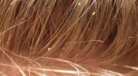 How to Identify Lice & Nits (Lice Eggs)