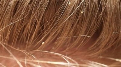 How to Check for Head Lice, Nits & Lice Eggs | Identification Guide
