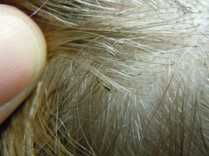 How to Identify Lice & Nits (Lice Eggs)